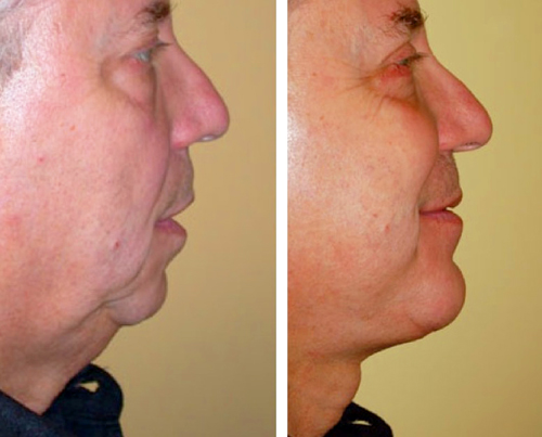 Chin Contouring | PERFECT FACE | Facial LASER Aesthetics Clinic ...