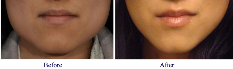 Jaw-line Contouring | PERFECT FACE | Facial LASER Aesthetics Clinic ...