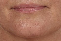 Mental Crease | PERFECT FACE | Facial LASER Aesthetics Clinic ...