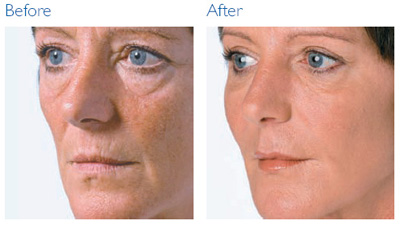 Cheek Enhancement | PERFECT FACE | Facial LASER Aesthetics Clinic ...