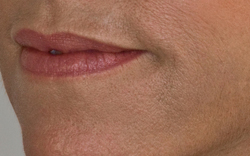 Parentheses Lines | PERFECT FACE | Facial LASER Aesthetics Clinic ...