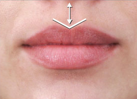 Lip Augmentation | PERFECT FACE | Facial LASER Aesthetics Clinic ...