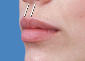 Lip Augmentation | PERFECT FACE | Facial LASER Aesthetics Clinic ...