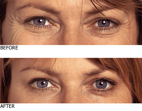 Crows Feet | PERFECT FACE | Facial LASER Aesthetics Clinic | Portimao ...