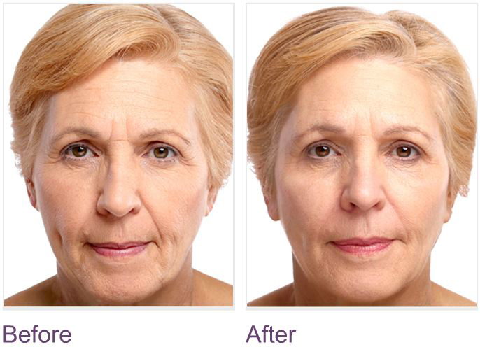 Mesolift | PERFECT FACE | Facial LASER Aesthetics Clinic | Portimao ...