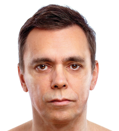 Upper Cheek Wrinkles | PERFECT FACE | Facial LASER Aesthetics Clinic ...