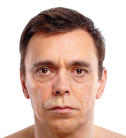 Upper Cheek Wrinkles | PERFECT FACE | Facial LASER Aesthetics Clinic ...